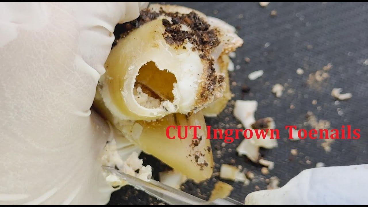 CUT Ingrown Toenails, Toenails with Maggots, Fungal Toenails ...