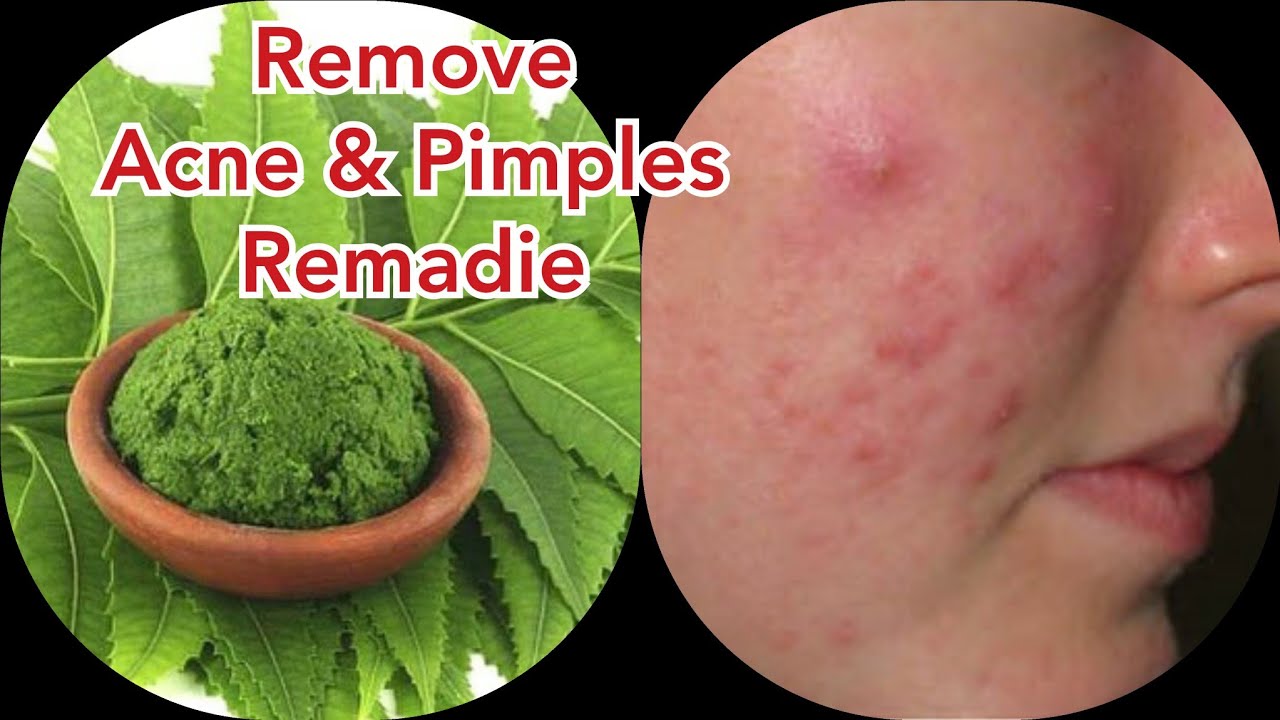 How To Remove ACNE & PIMPLES at home (100% Effective Results) - YouTube