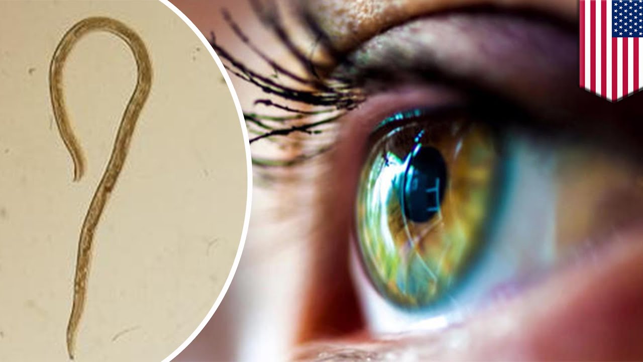14 worms pulled from Oregon woman's eye in rare cattle worm infection ...