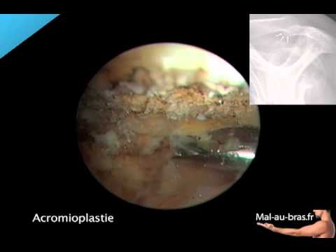Acromioplastie - Acromioplasty - YouTube
