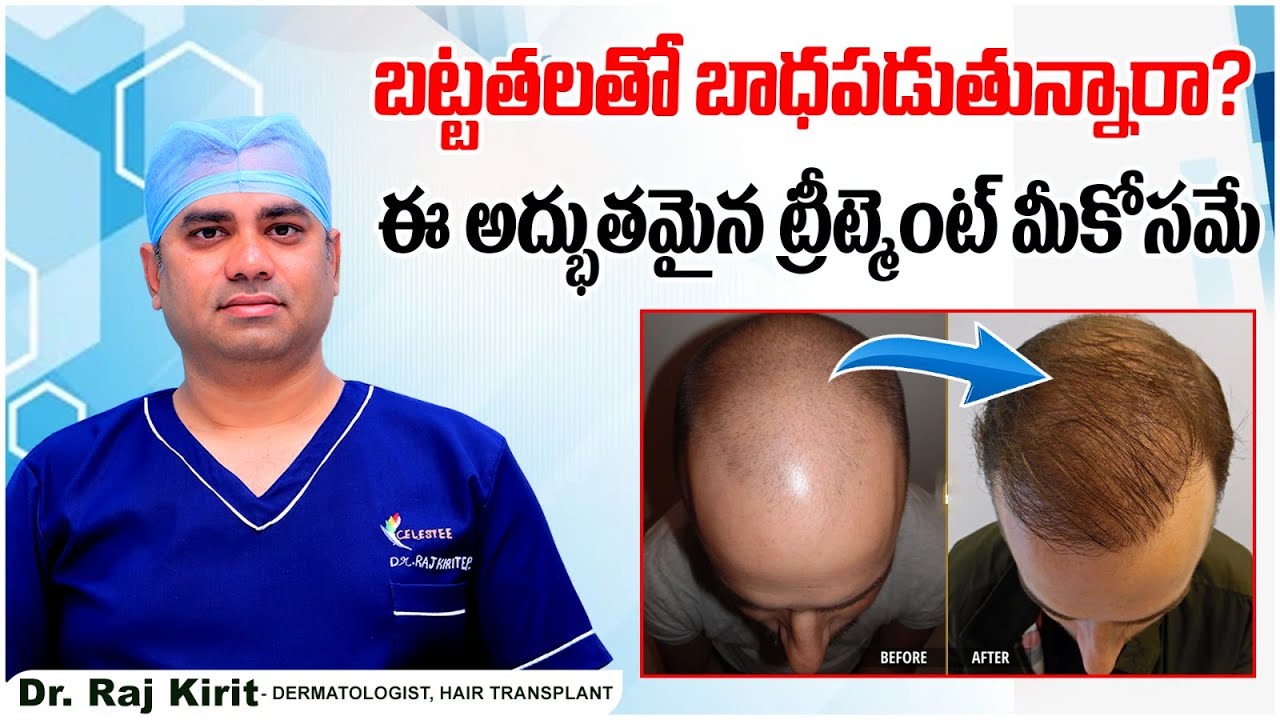 బట్టతలతో బాధపడుతున్నారా? | Best Solution for Baldness | Hair Growth ...