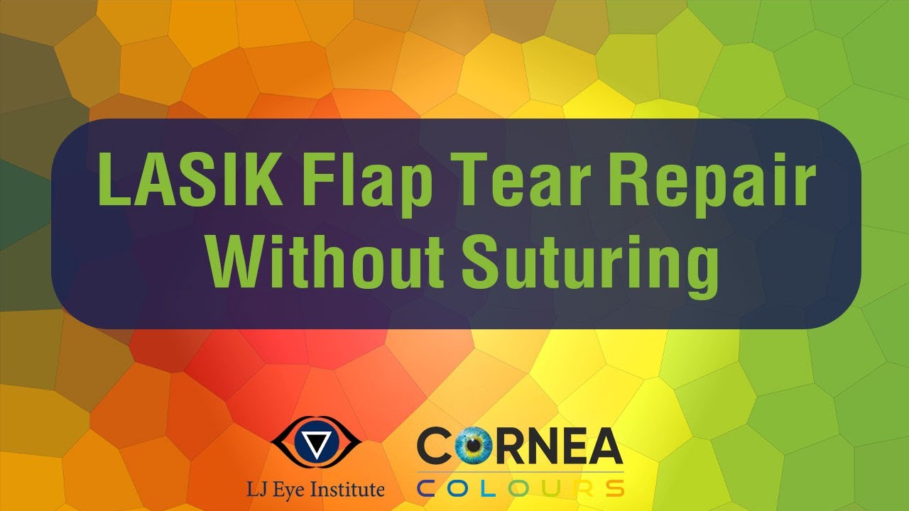 LASIK Flap tear repair without Suturing - YouTube