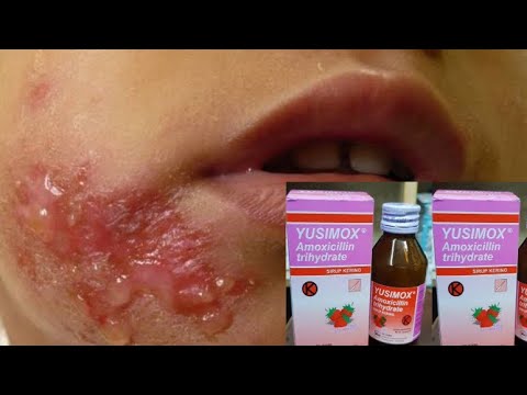 Informasi Sirup amoxicillin untuk mengatasi berbagai infeksi Bakteri ...