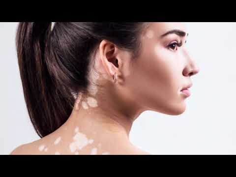 Vitiligo Nedir ? Belirtileri Neler ? Nasıl Tedavi Edilir ? Yapılması Gerekenler
