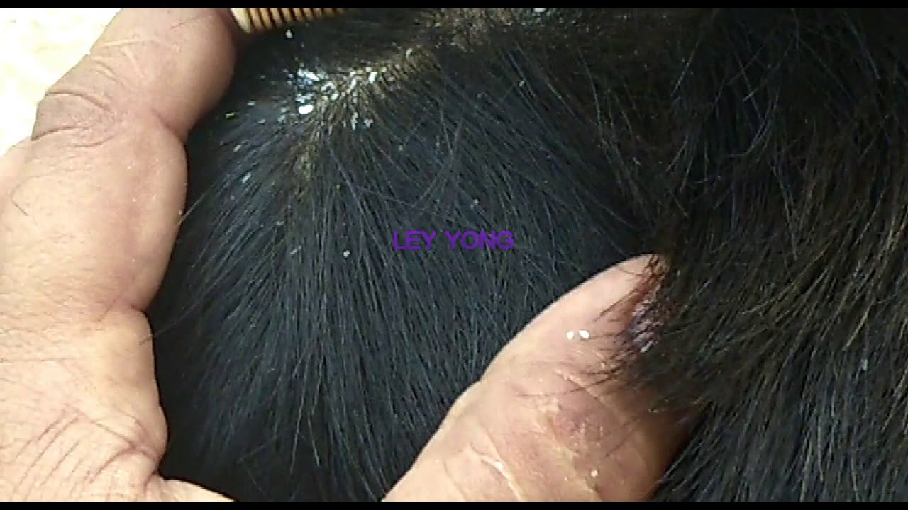 Dandruff Scratching | Dry Flaky Scalp \ Huge Flakes \Scalp Scratching ...