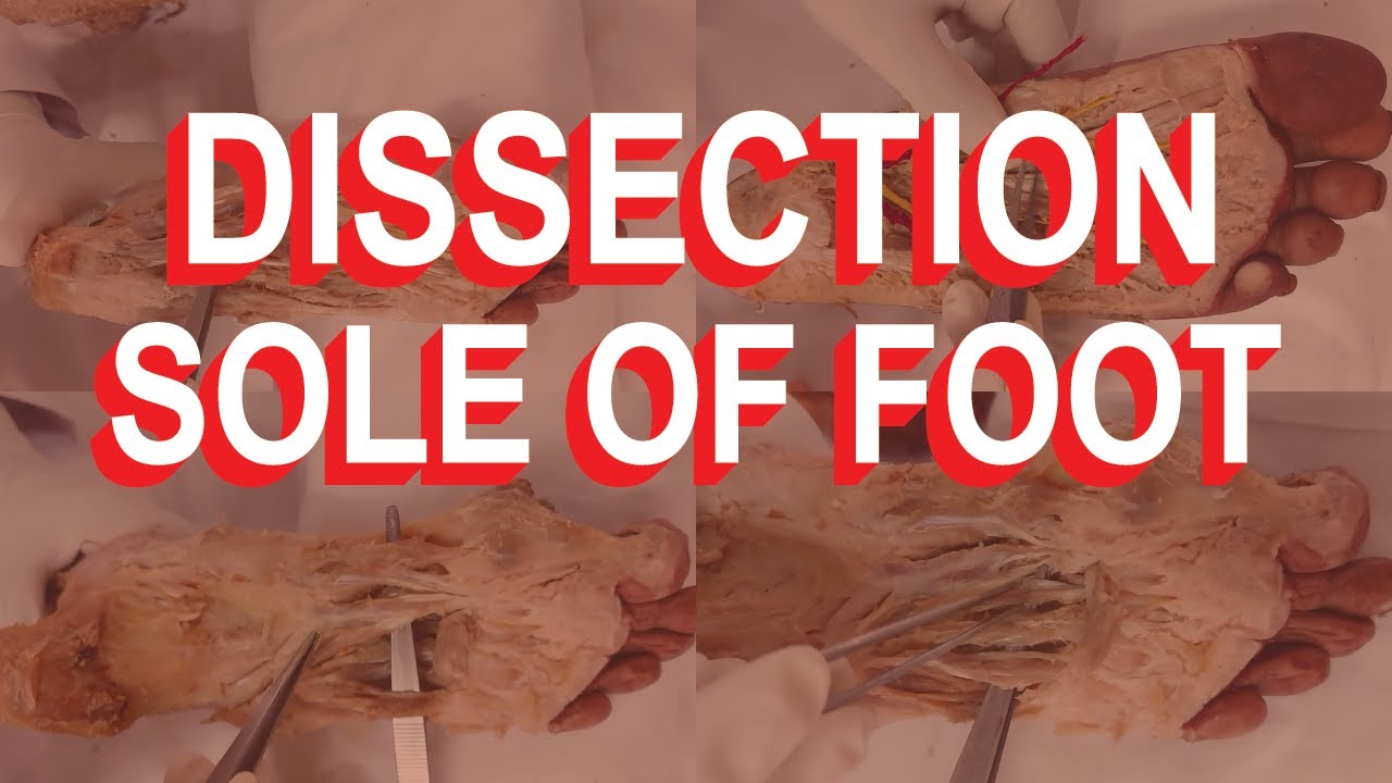 Dissection: Sole of Foot (all four layers) - YouTube