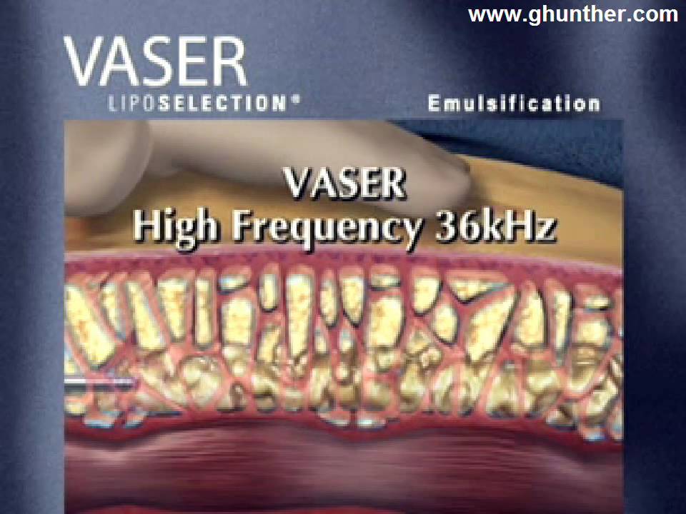 Tecnología Vaser Lipo: Resumen de procedimiento - YouTube