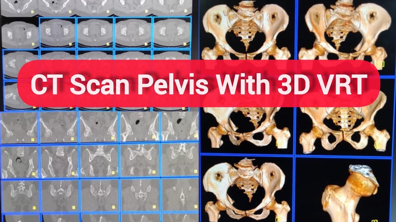 CT Scan Pelvis With Both Hip Joint | CT Scan Hip Joint | #Ctscanpelvis ...