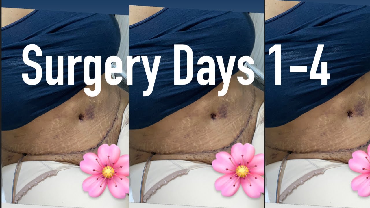SURGERY VLOG PART 3 (Surgery days 1-4) - YouTube