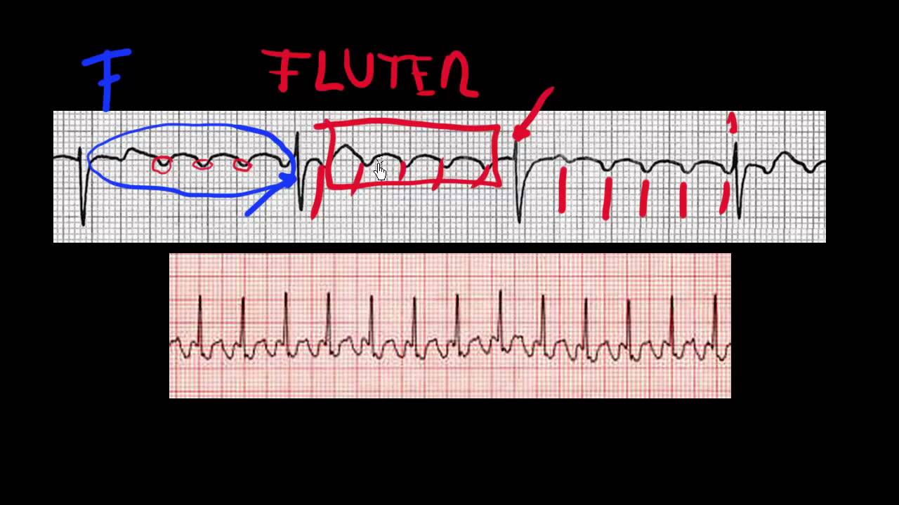 CURSO DE ELECTROCARDIOGRAFIA 26 - ONDA P - YouTube