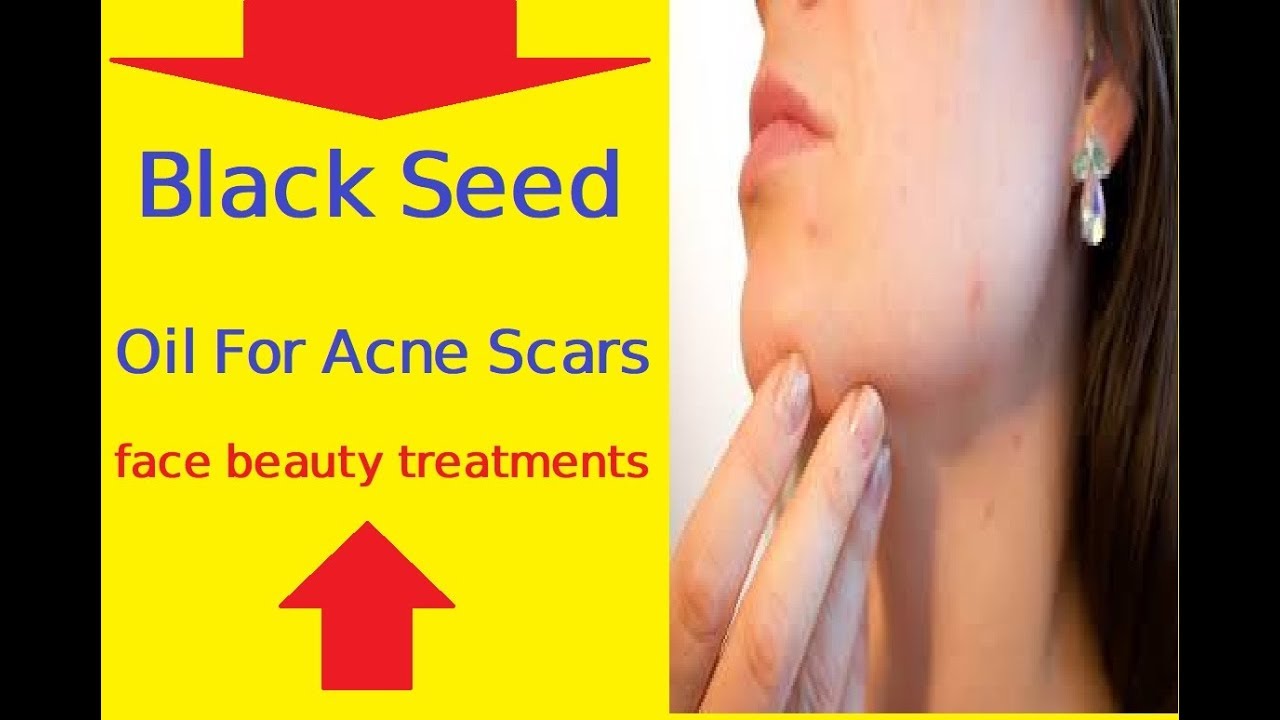 How To Make Useful Use Of Black Seed Oil For Acne Scars YouTube how-to-make-useful-use-of-black-seed-oil-for-acne-scars-youtube