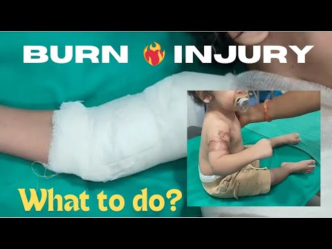 Burn ️‍🔥 injury in kids - How to apply dressing| Antiseptic dressing of ...