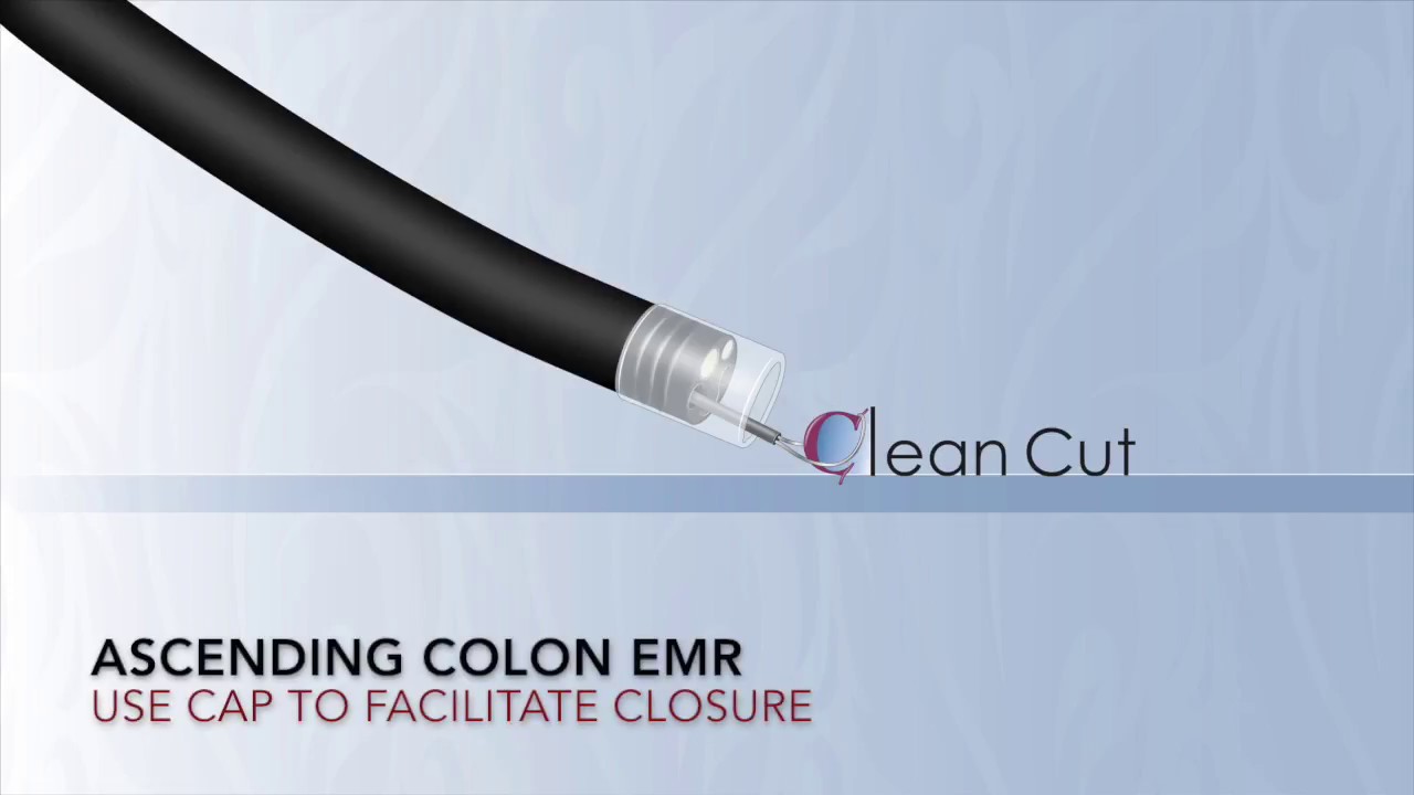 Colonoscopy: Ascending Colon Polyp EMR+APC+Clip - Audio - YouTube