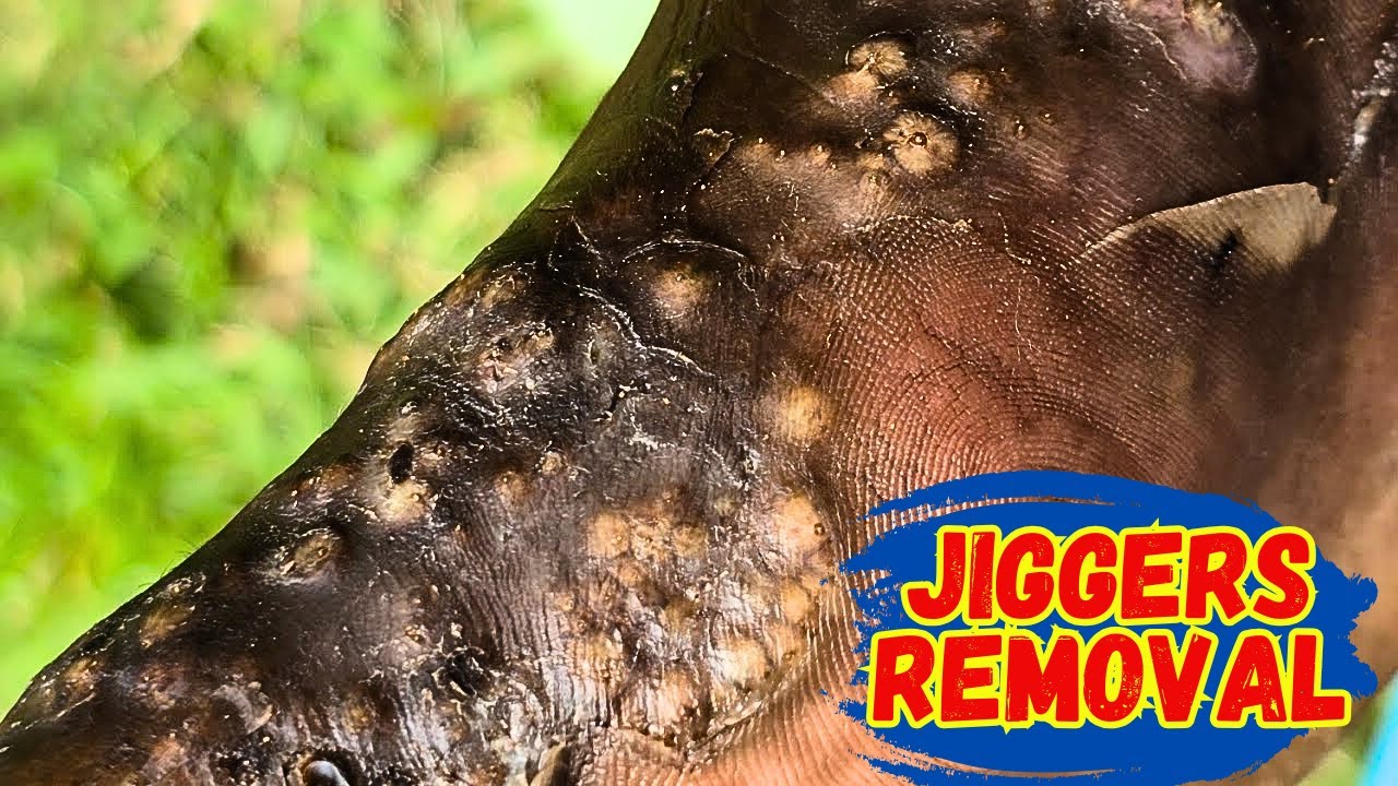 Jiggers Explained: Shocking Removal Methods & Prevention Tips 🚫 - YouTube
