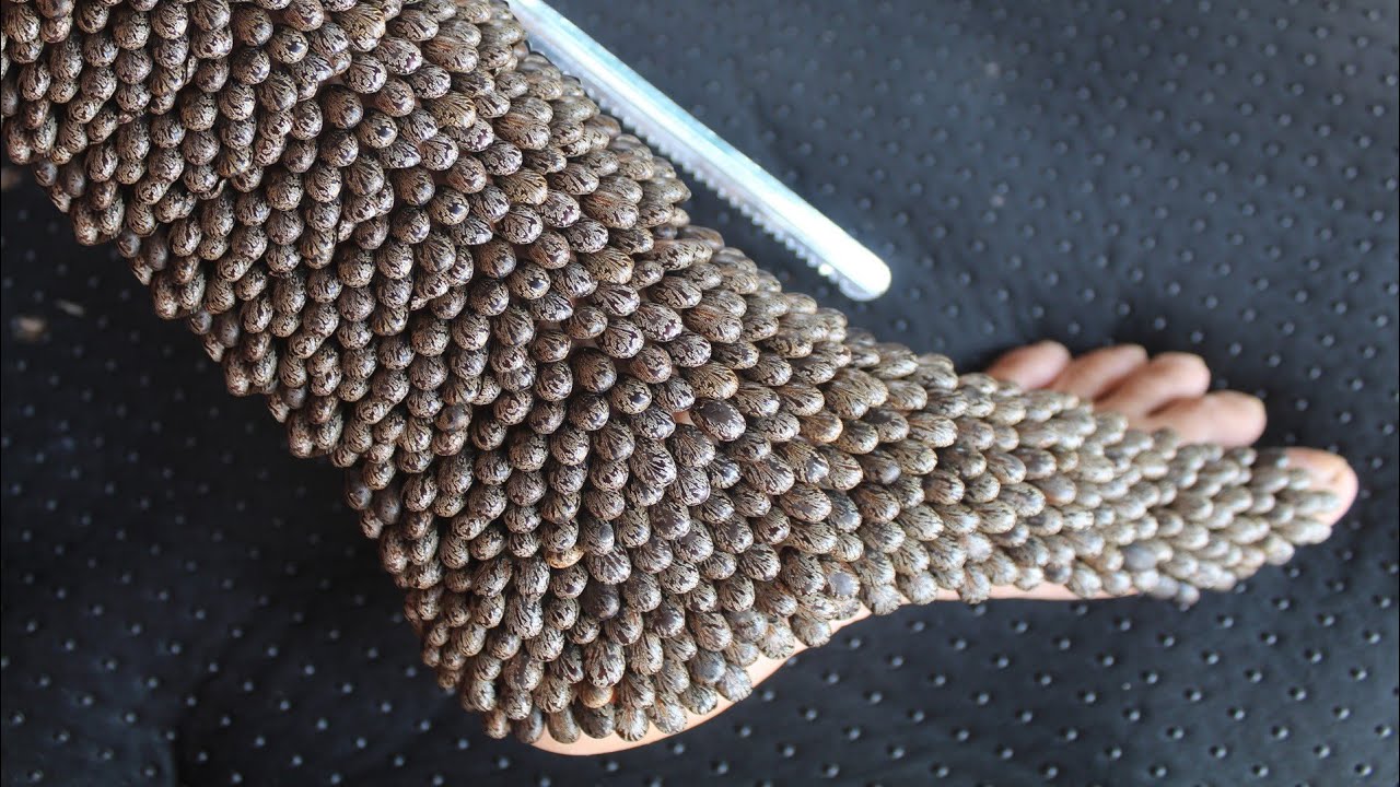 Help Remove Seeds Ticks On Leg Woman With Saw #1734 - YouTube