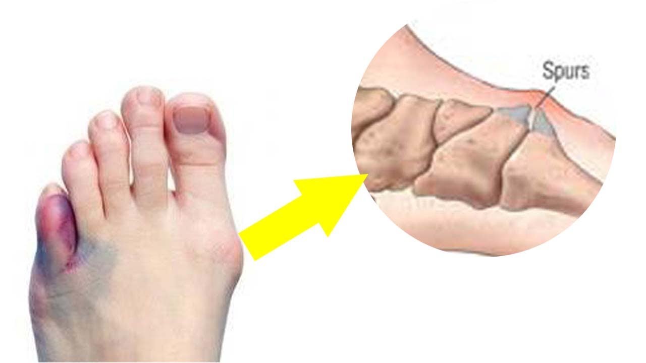 Home Remedies for Bone Spurs || How to cure Bone Spurs - YouTube