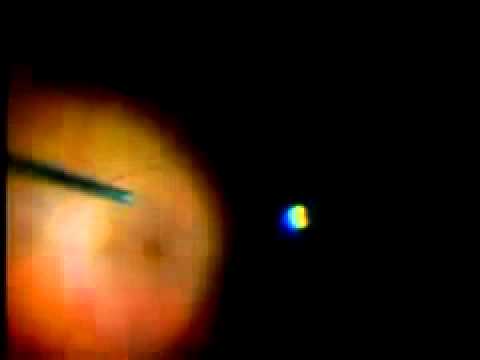 25 Gauge Vitrectomy 1 - YouTube