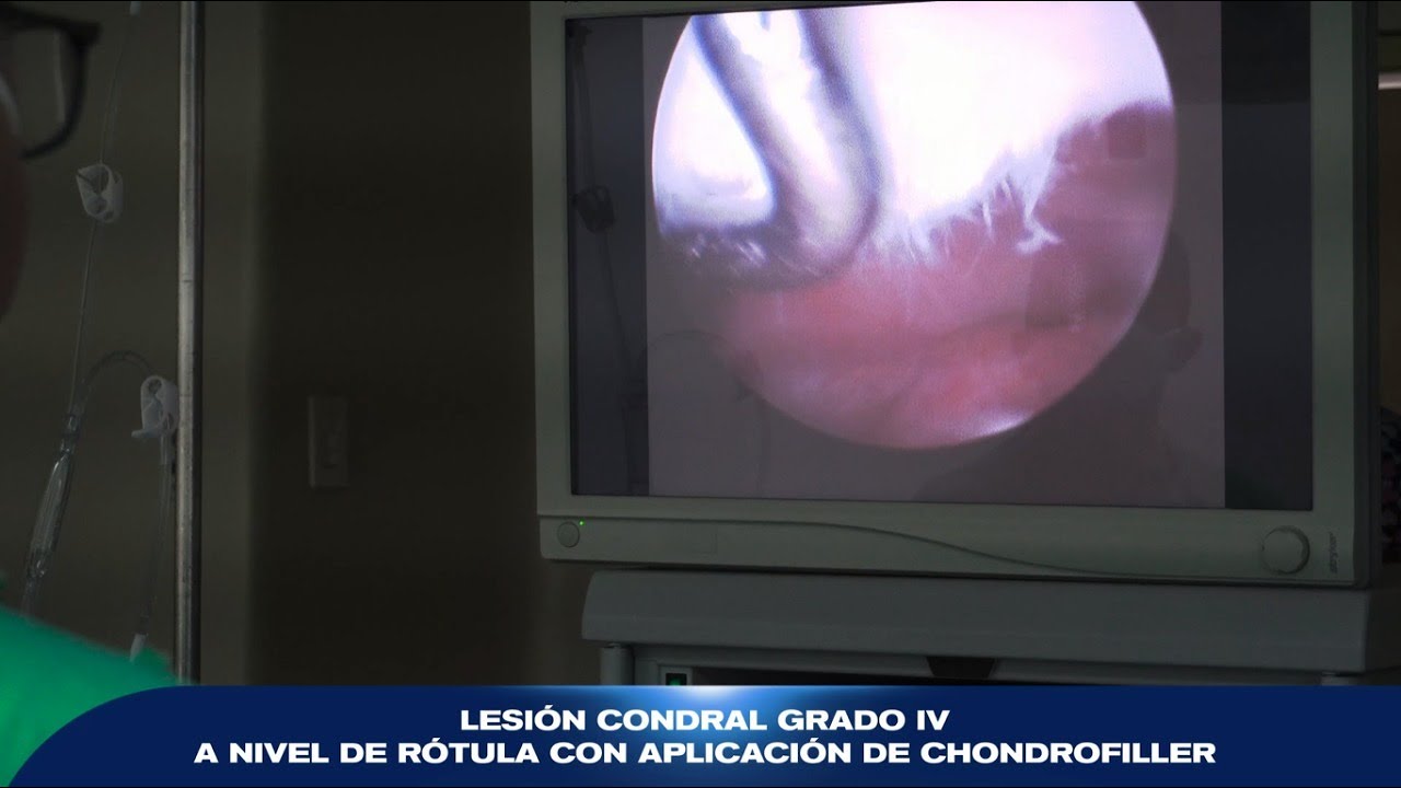 Artroscopia de lesión condral grado IV a nivel de rótula con ...