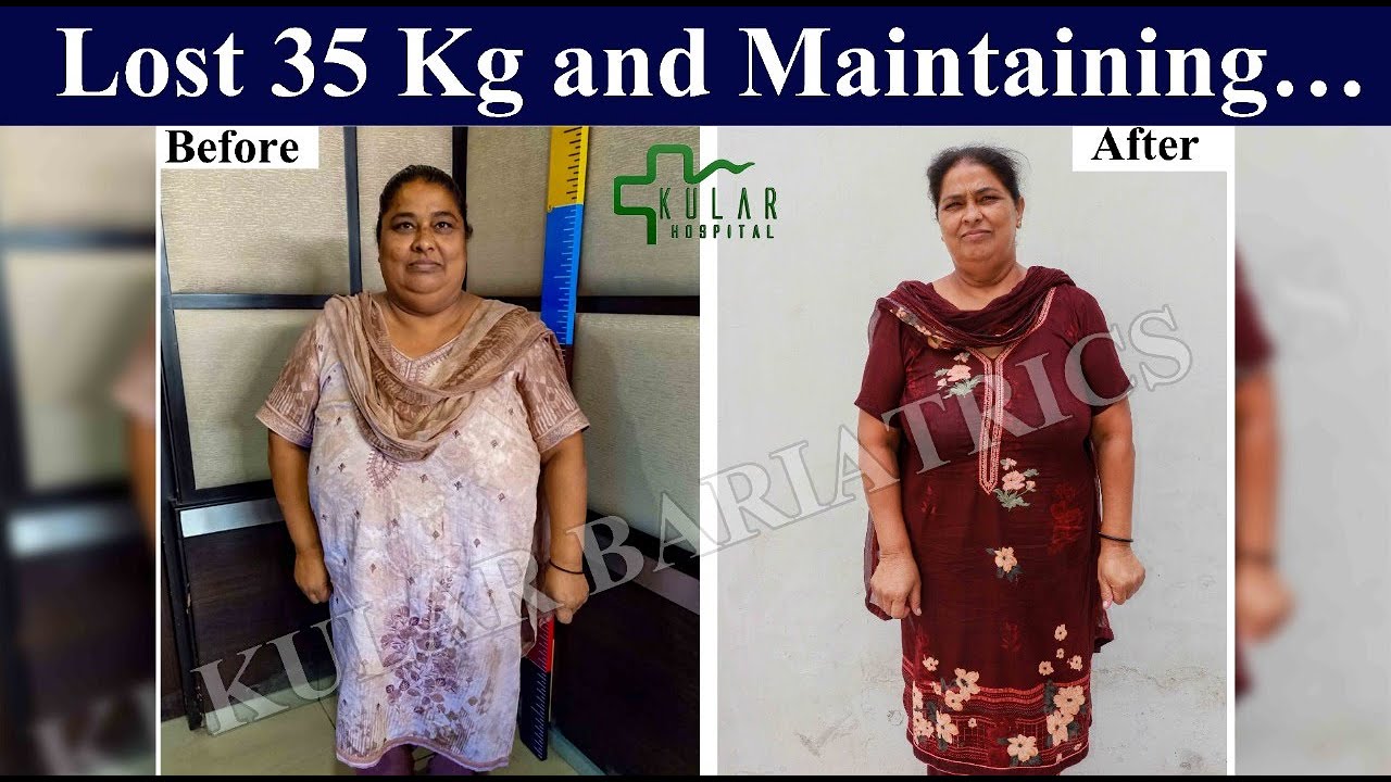 3 years after Weight Loss Surgery, How to Handle? - YouTube