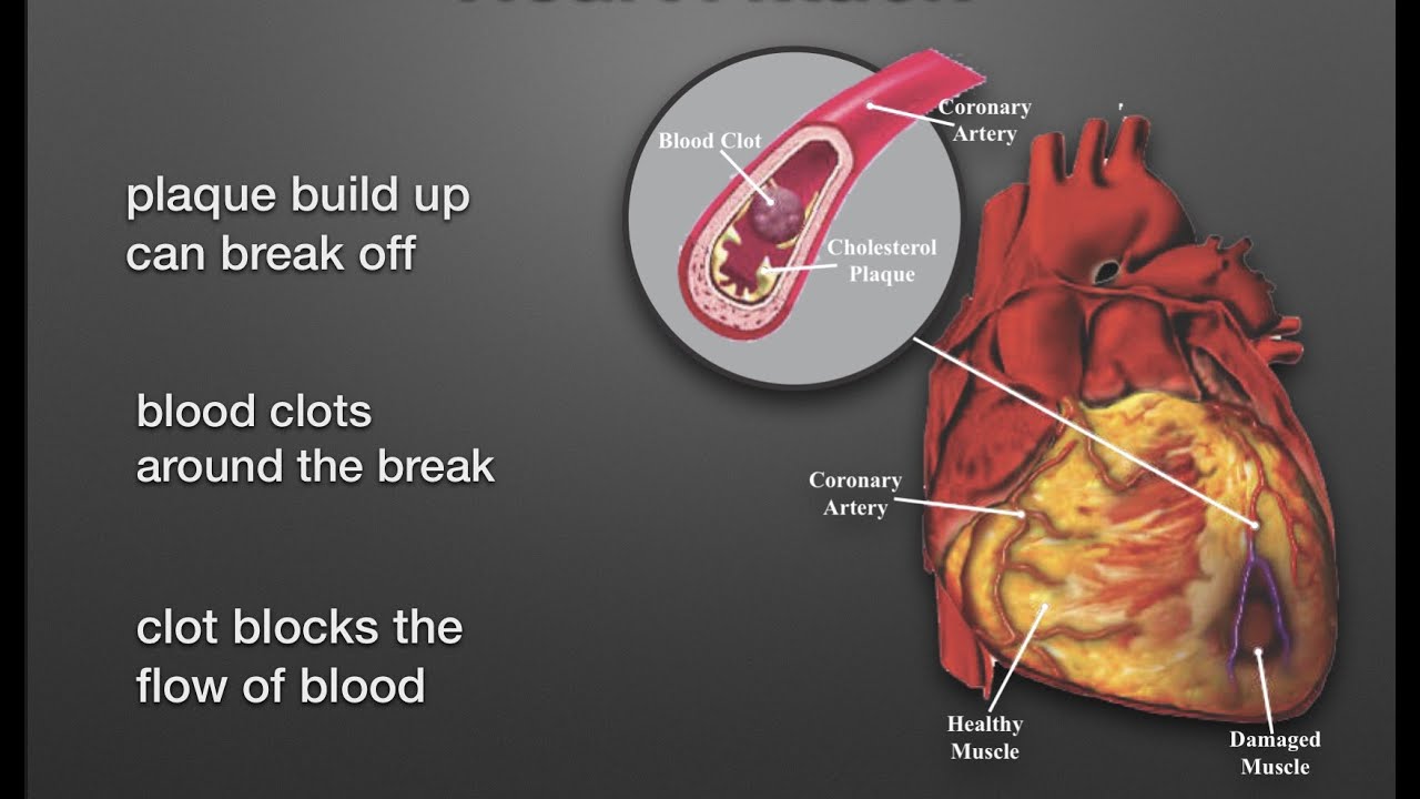 Heart Attack|Circulatory Sytem Health Problems|Online Class|ACSP EP ...