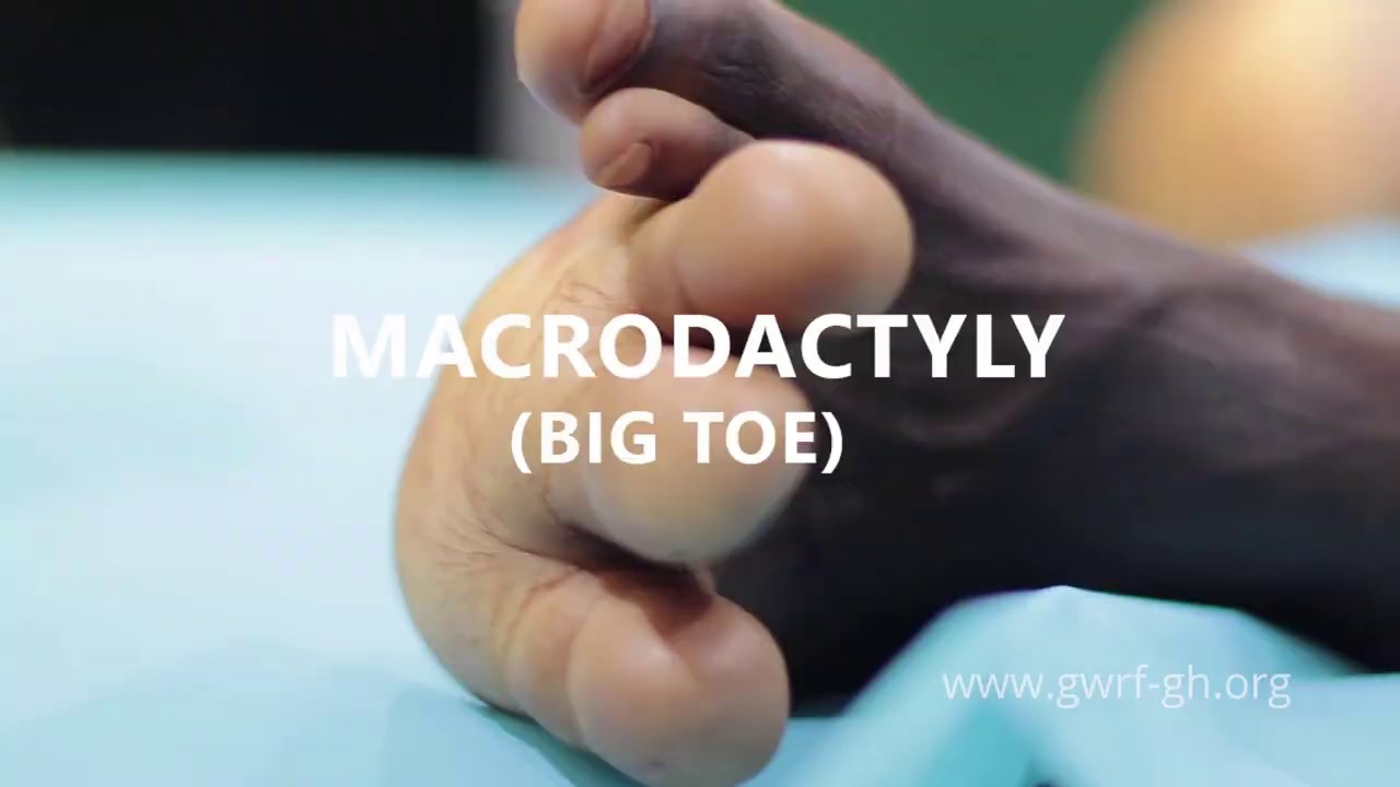 Case of the Day - Macrodactyly - YouTube