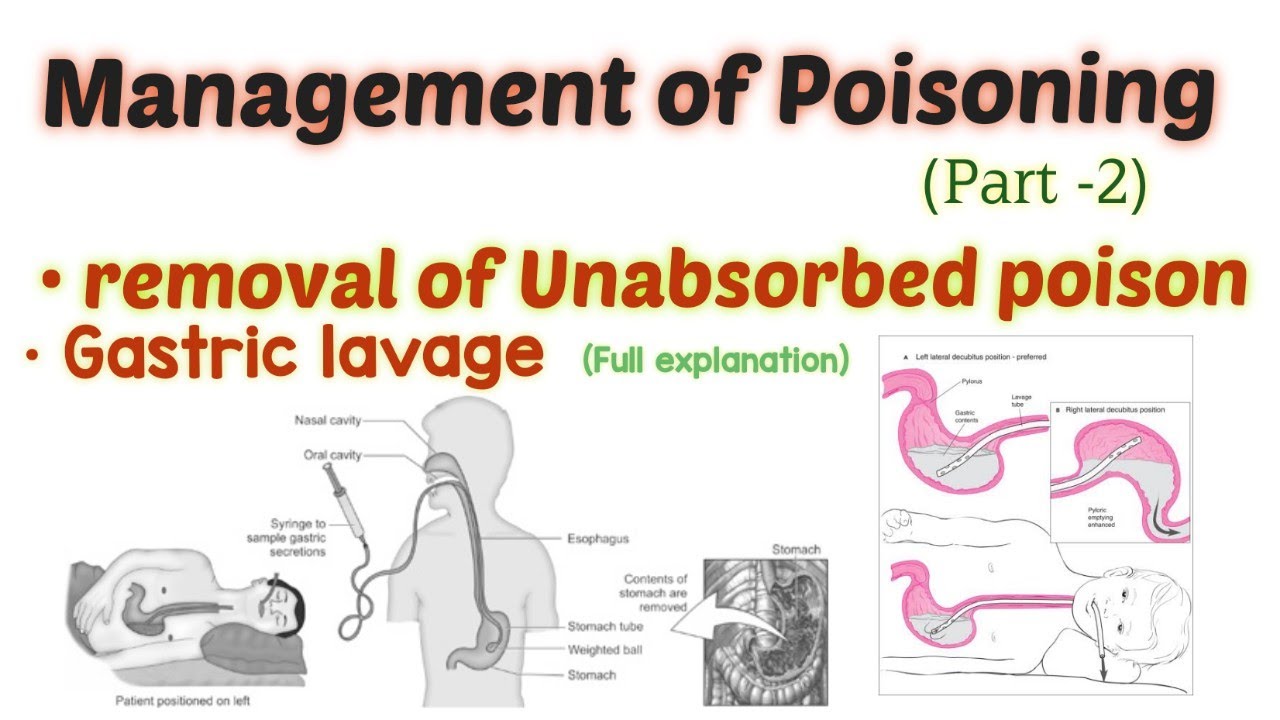 Gastric Lavage Strong, Durable And Reusable Medical Gastric Lavage