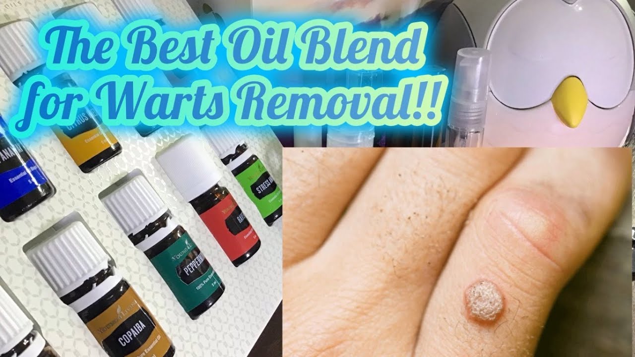 Essential Oils for Warts Removal - YouTube