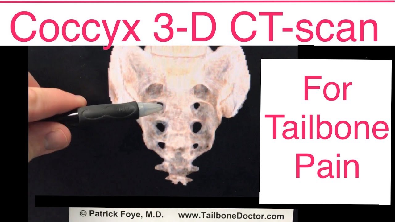 3-D CT Scan for Tailbone Pain, Coccyx Pain, CAT scan - YouTube