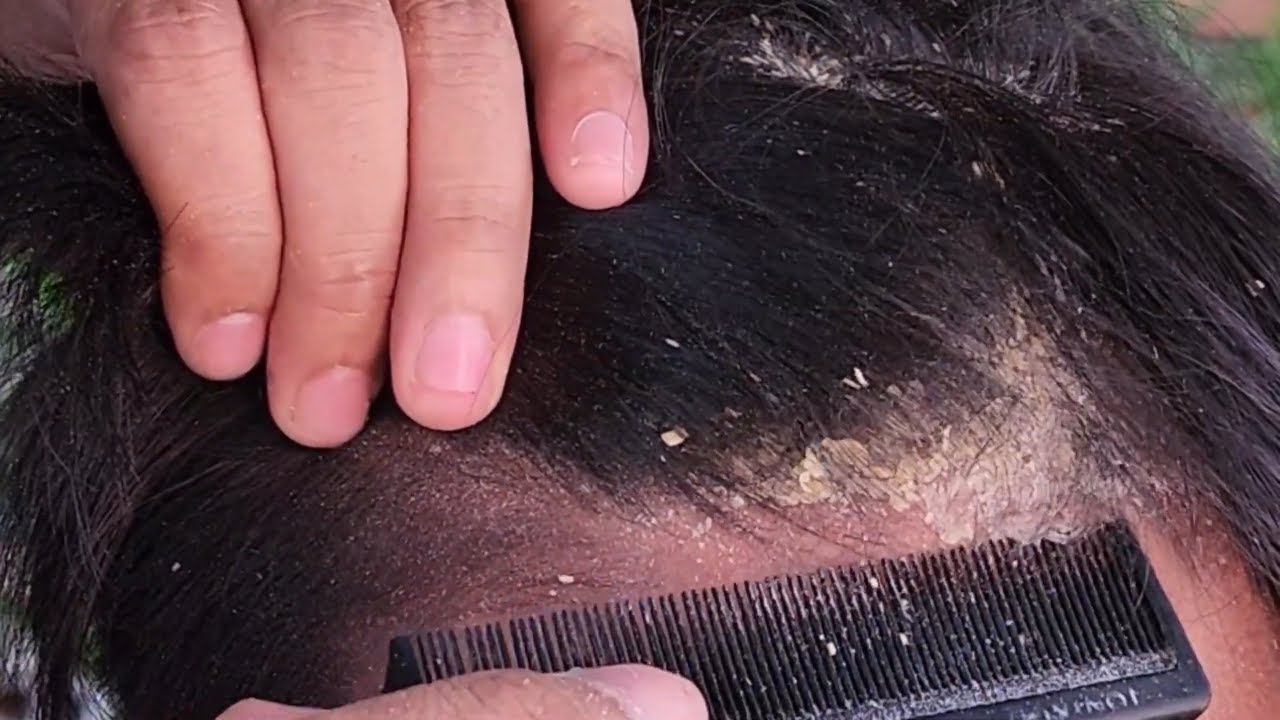 ASMR Scalp Scratching for Sleep and Relaxing Care #460 - YouTube