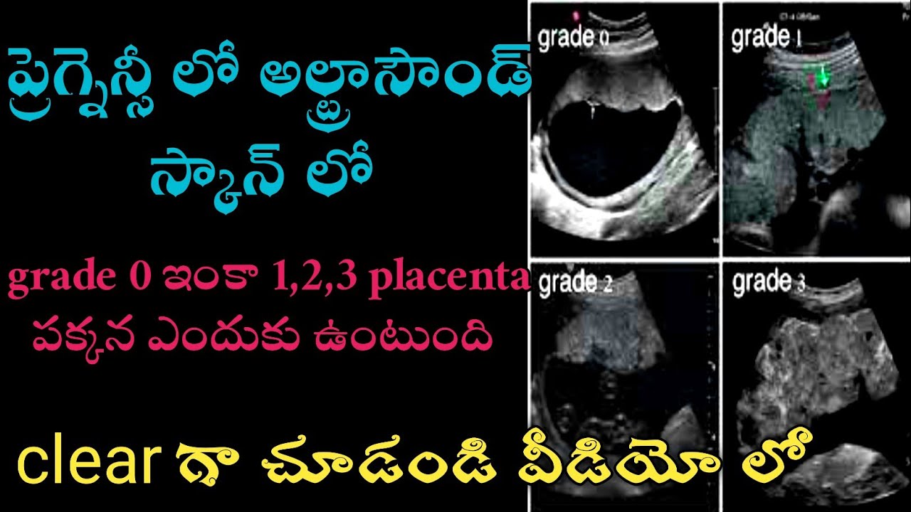 what is the meaning of grade in ultrasound report | placenta grade 1 ...