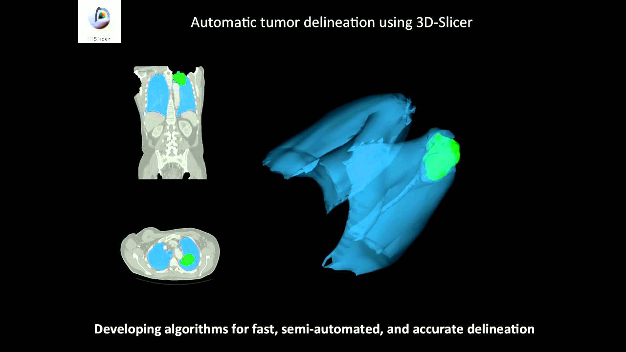 Hugo Aerts plenary talk: Radiomics -- There is More Than Meets the Eye ...