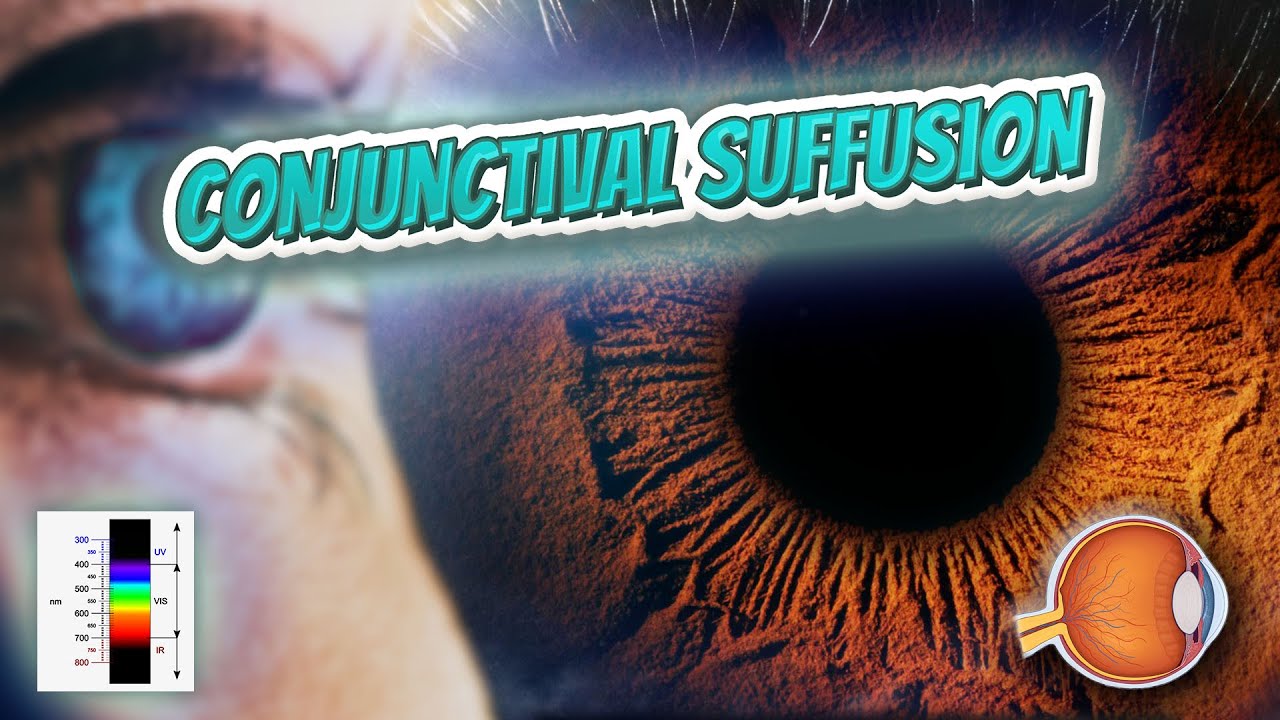 Conjunctival suffusion - Your EYEBALLS - EYNTK 👁️👁️💉😳💊🔊💯 - YouTube