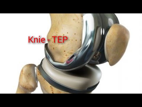 Knie - TEP, Ursache, Diagnose und Therapie - YouTube