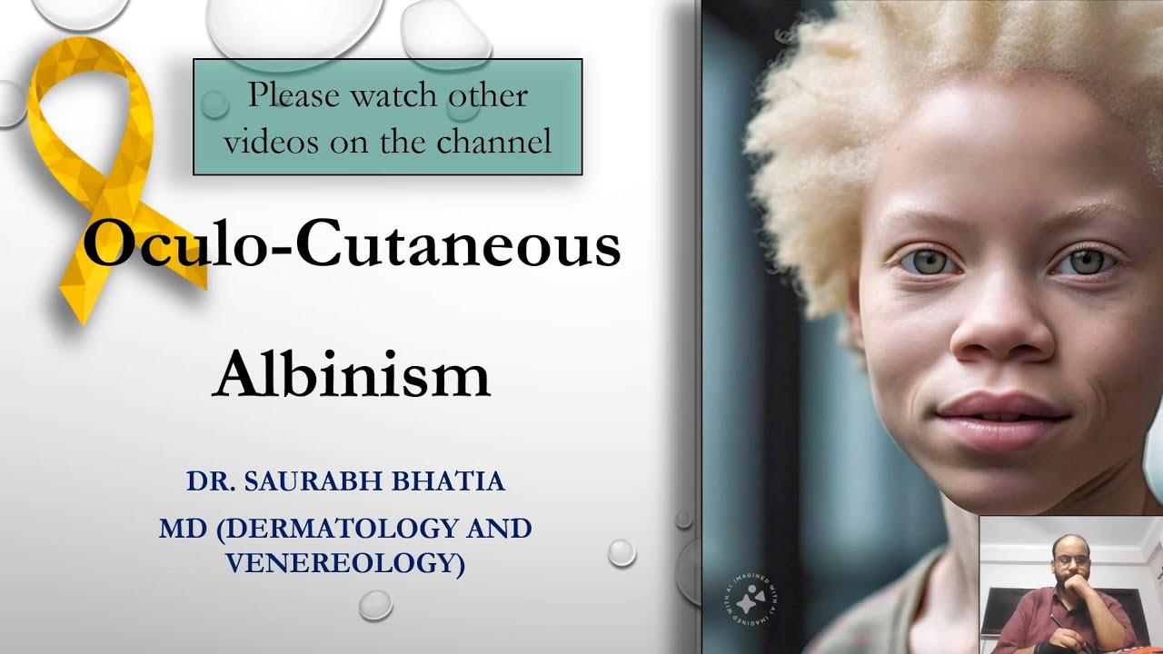Oculo-cutaneous Albinism: Disorder, Pathology, and Sub-types - YouTube