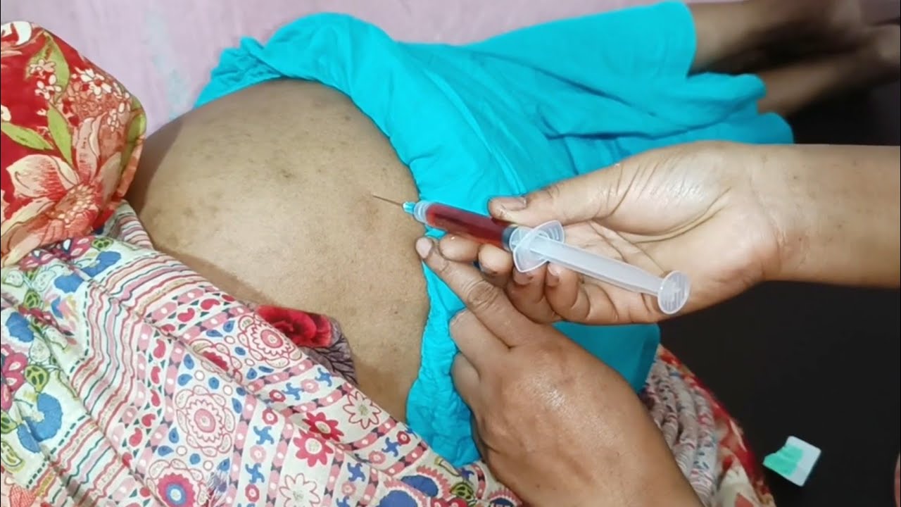 Injection Video. Buttock injection.im injection. iv injection push 25 ...