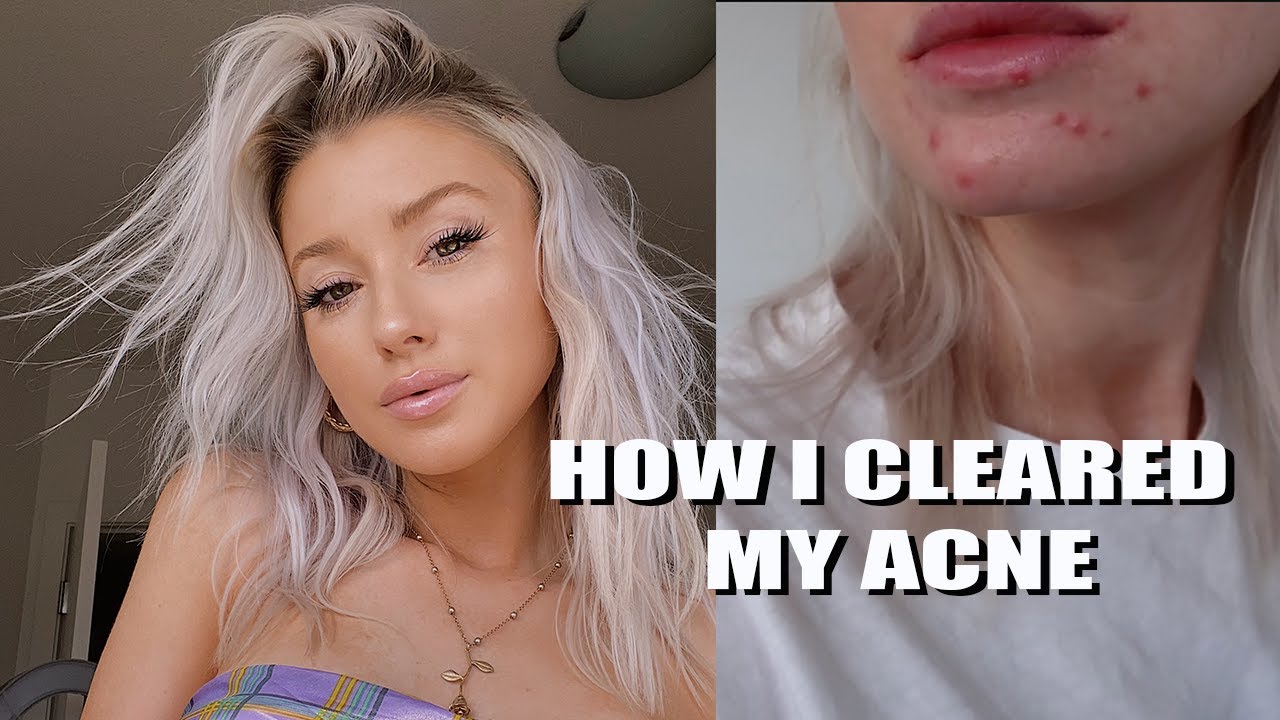 products that helped clear my acne | lolaliner - YouTube