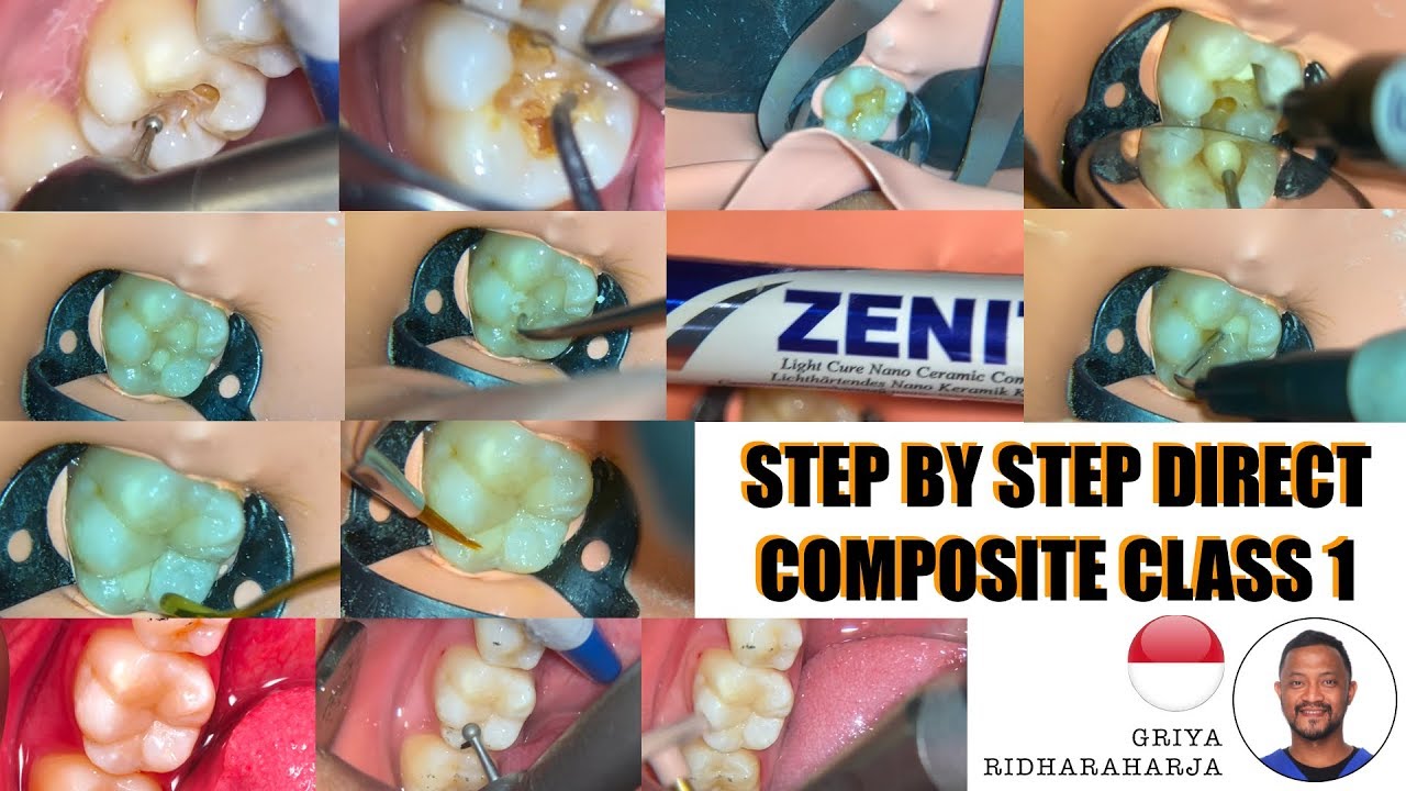 DIRECT RESTO FULL PROCEDURE CLASS 1 - YouTube