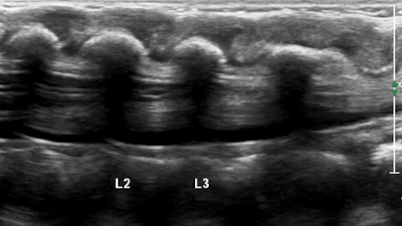 Spinal US - Low conus - YouTube