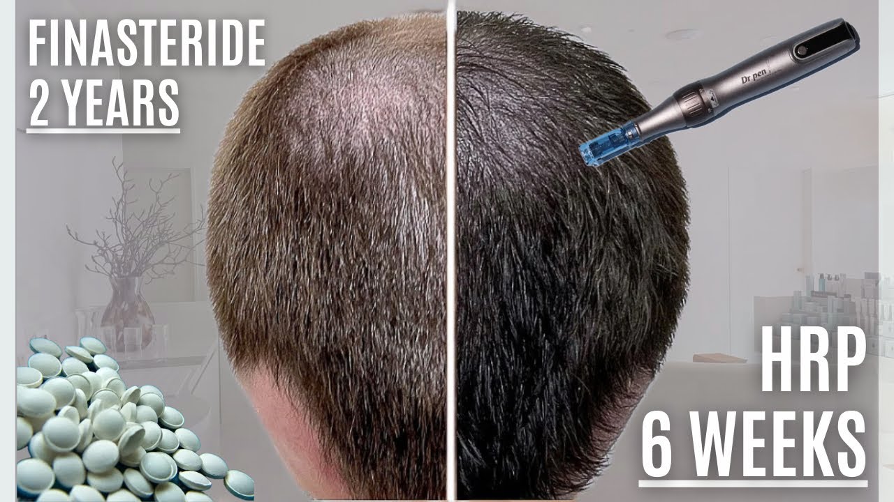 The New Finasteride Alternative No One Has Told You About - YouTube