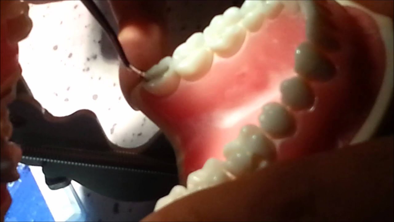 Class I + II cement procedure BY GIC - YouTube