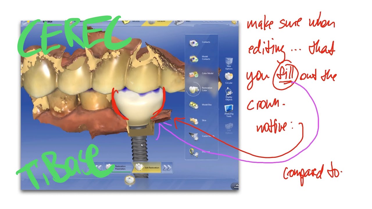 CEREC TiBase Crown #19 - YouTube