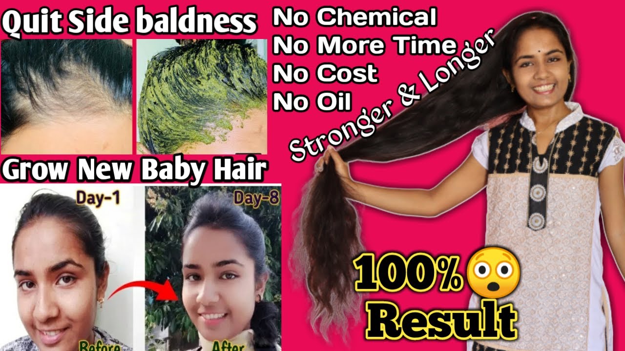 30 Days Challenge Grow New Hair On Bald Head Naturally | Get Thicker ...