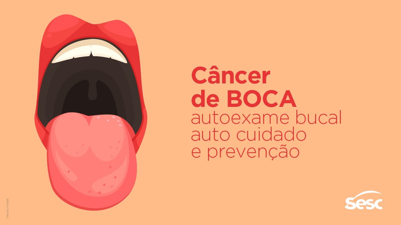 Câncer de boca - sintomas e informações importantes - YouTube