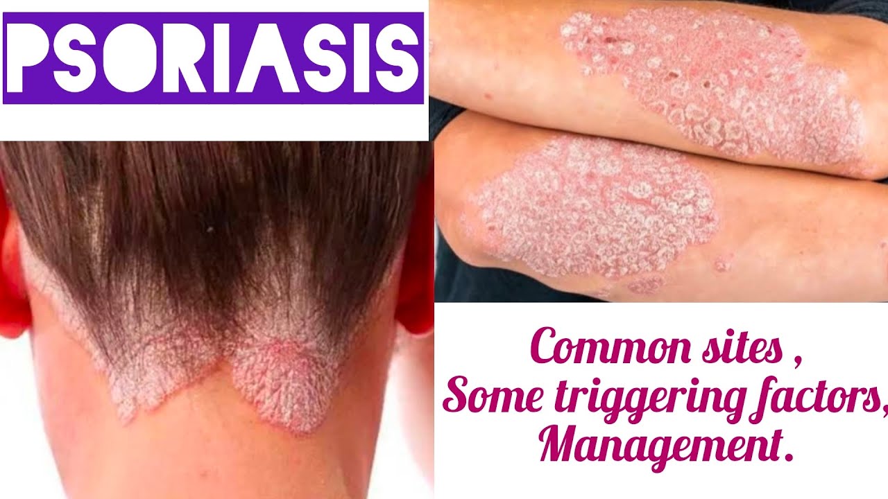 Psoriasis!Common sites,some risk factors & management.#psoriasis# ...