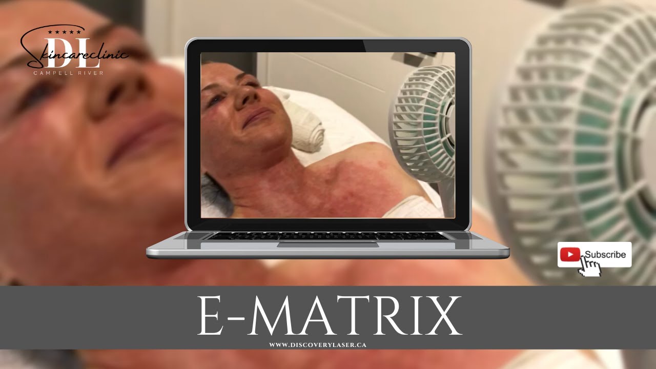 eMatrix Full Face Sublative Skin Rejuvenation - YouTube