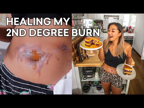 How Long To Recover From Second Degree Burn