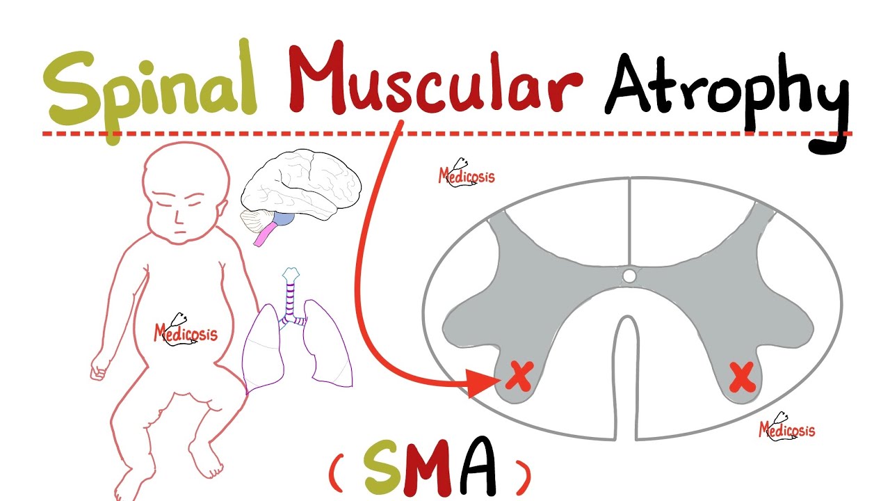 Spinal muscular atrophy (SMA) -Werdnig-Hoffman disease -Anterior horn ...