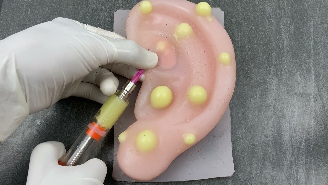 Pimple Popping on Hyper-Realistic Silicone Body Models! 🛑Live Stream ...