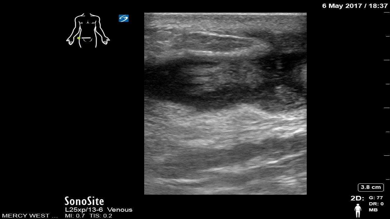 abscess swirl sign 1 - YouTube