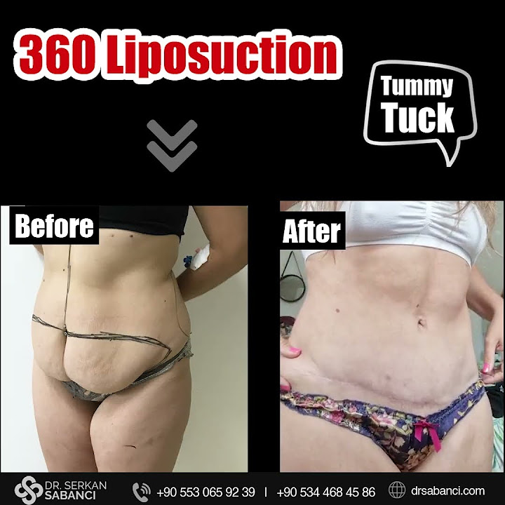 Tummy Tuck + 360 Liposuction | Op. Dr. Serkan Sabancı | Plastik Rekonstrüktif ve Estetik Cerrahi ...
